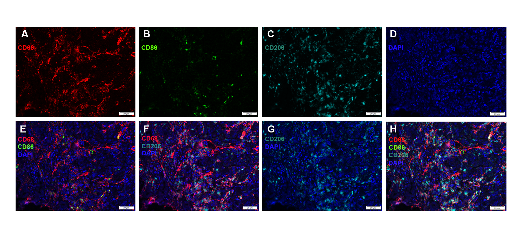CD86+/CD206+ tumor-associated macrophages predict prognosis of patients ...